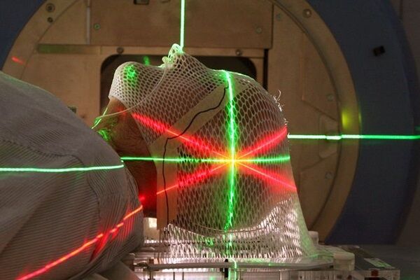 Radiocirurgia para o tratamento de Malformação Arteriovenosa (MAV) é ...